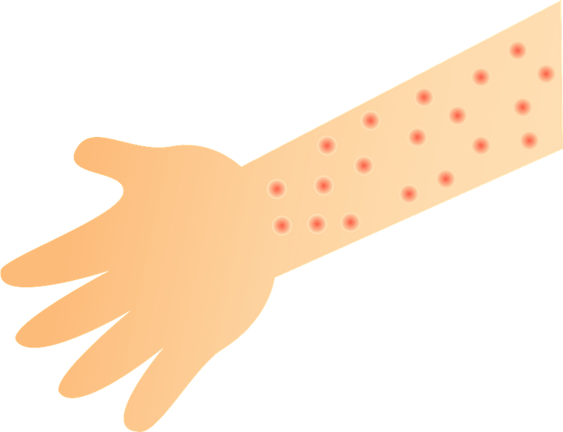 Arm with Skin Rash clipart. Free download transparent .PNG | Creazilla