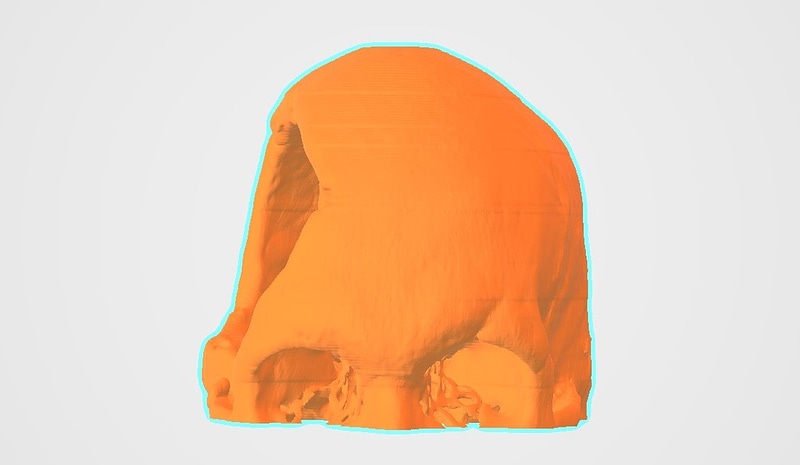 craniotomy - Free 3d model on creazilla.com